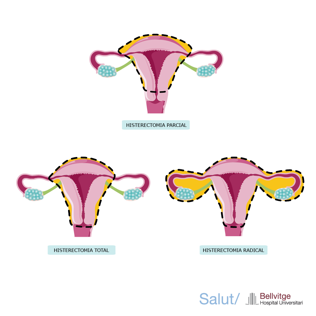 Histerectomia: informació a tenir en compte | Hospital de Bellvitge